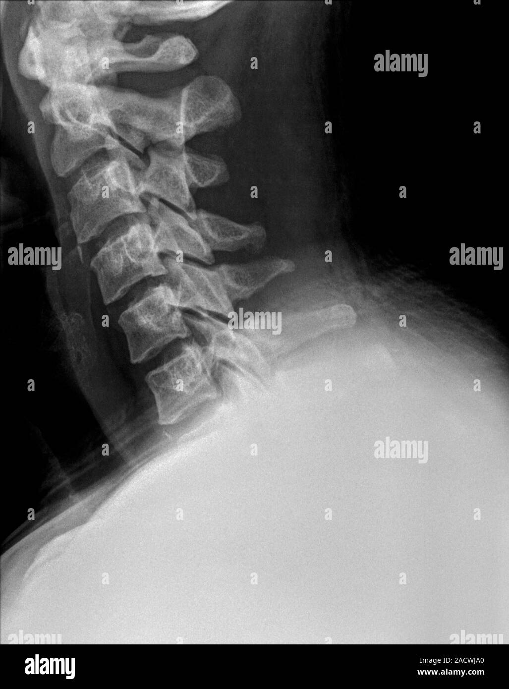 X-ray of a human Cervical spine Side View Stock Photo - Alamy