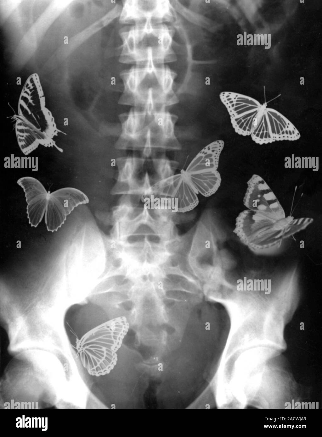 Concept - Butterflies in the stomach - x-ray of a human Abdomen with ...