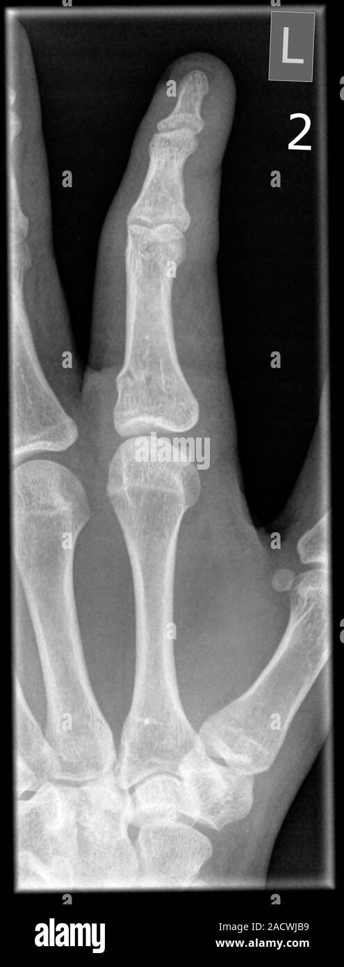 X-ray of the index finger there is a fracture of the proximally Phalanx ...