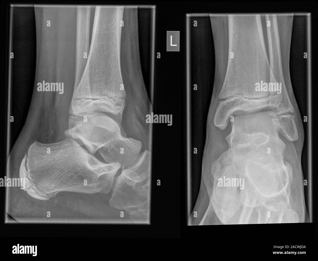 Healthy X-ray of an ankle 12 year old male Stock Photo - Alamy