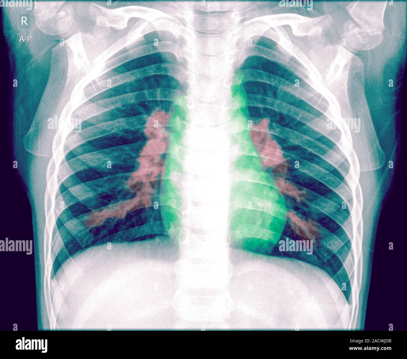 Chest x-ray of a 3 year old female baby with signs of pneumonia in both ...