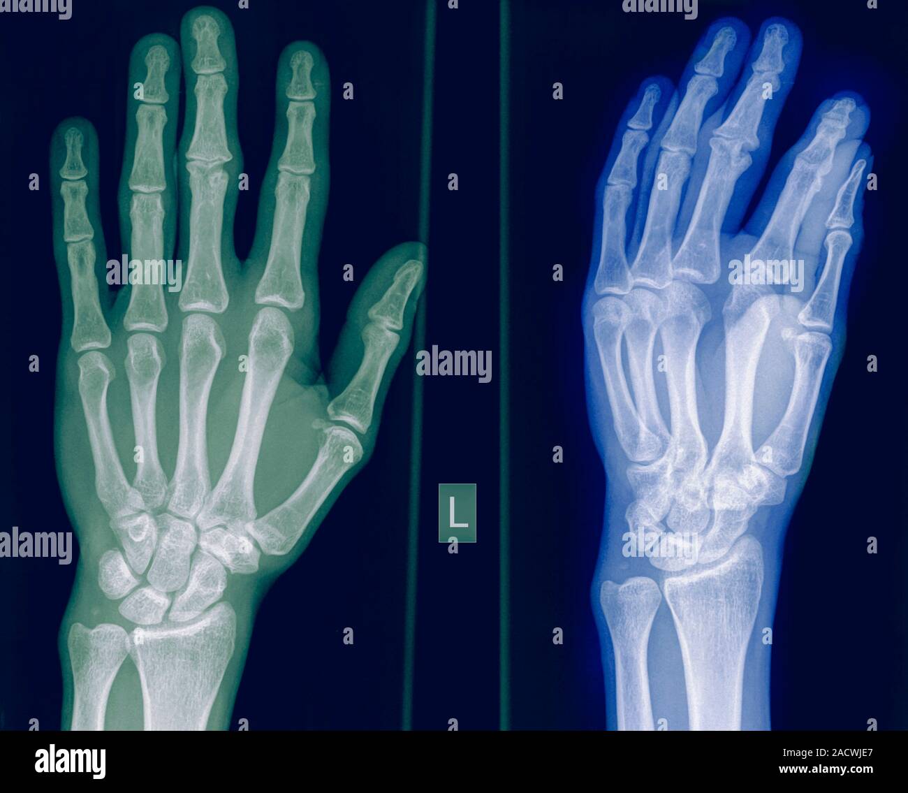 X-ray of a Human forearm with fat pad signs and a Supracondylar humerus ...