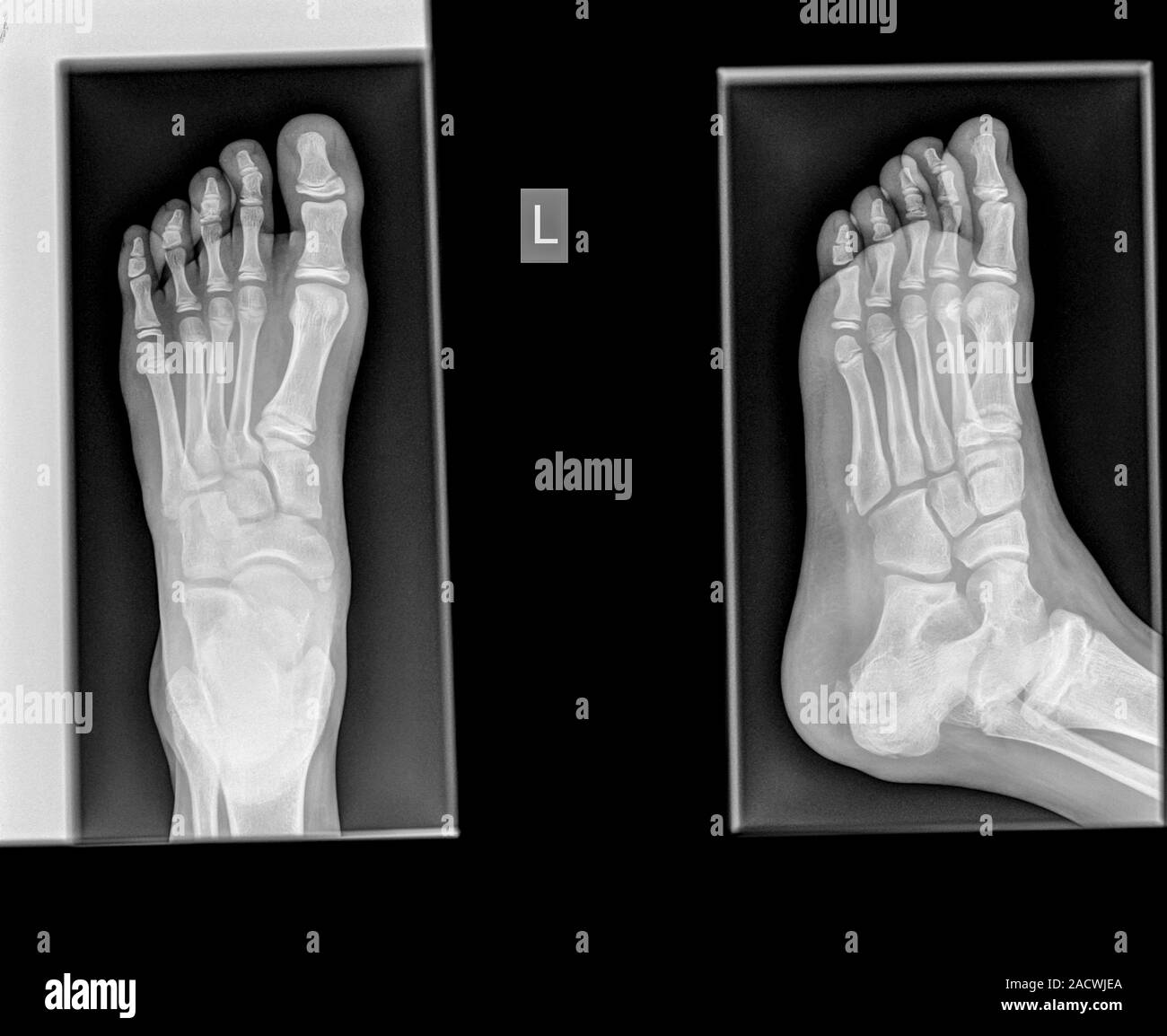 Healthy X-ray ofa foot of a 12 year old male Stock Photo - Alamy