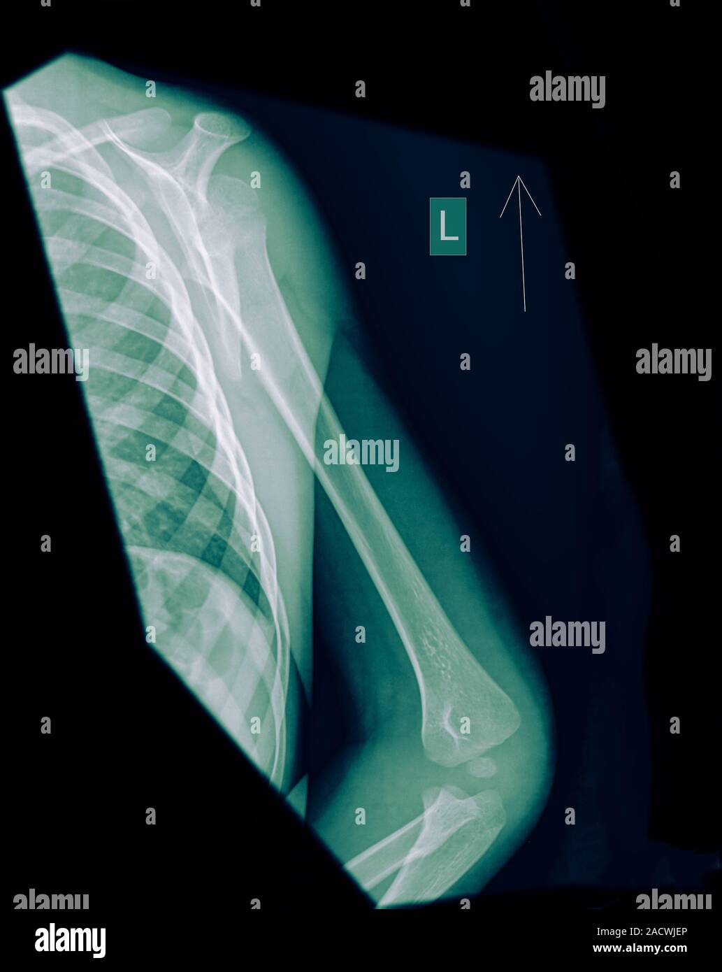 X-ray of a Human forearm with fat pad signs and a Supracondylar humerus ...