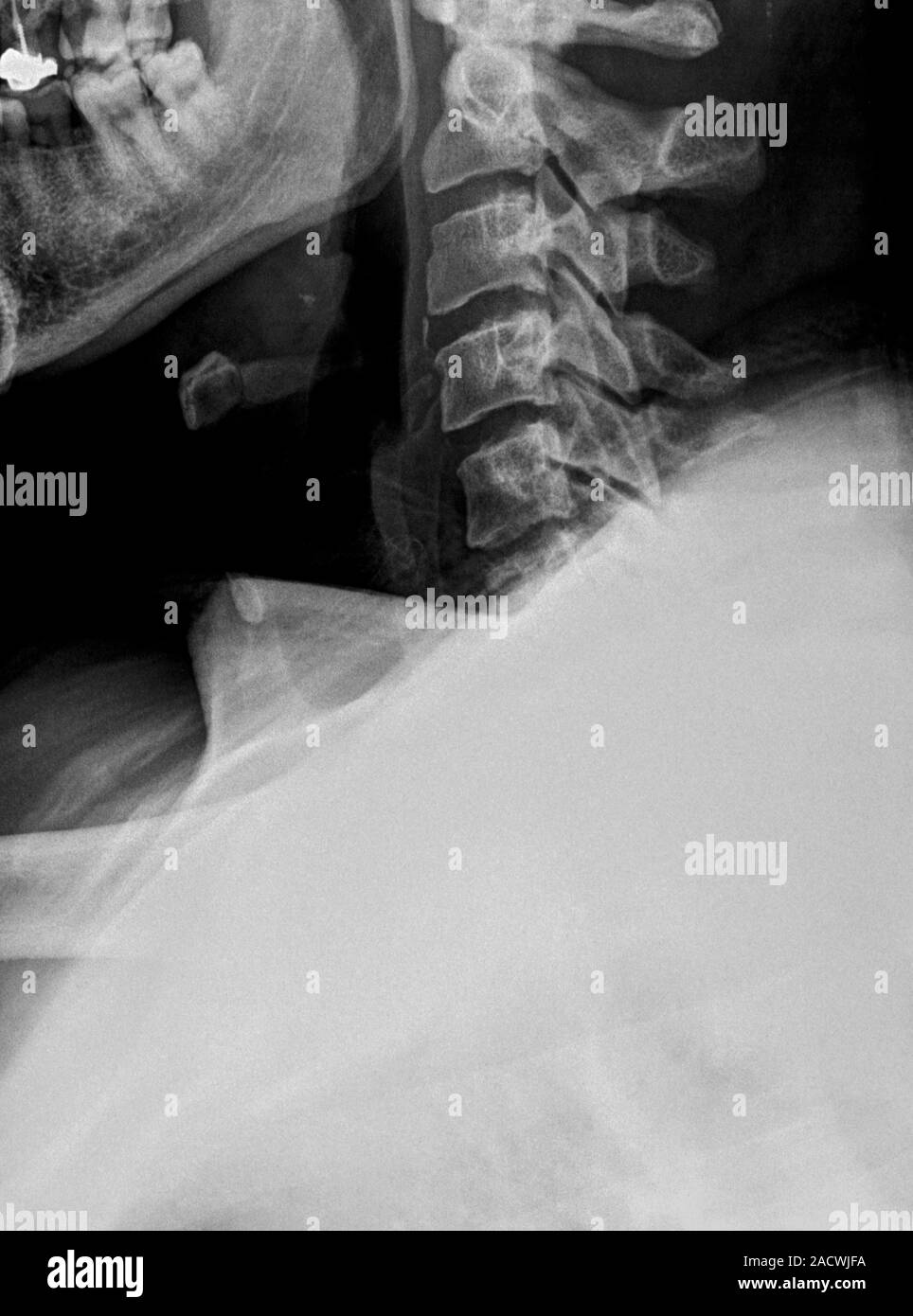 X-ray of a human Cervical spine Side View Stock Photo - Alamy