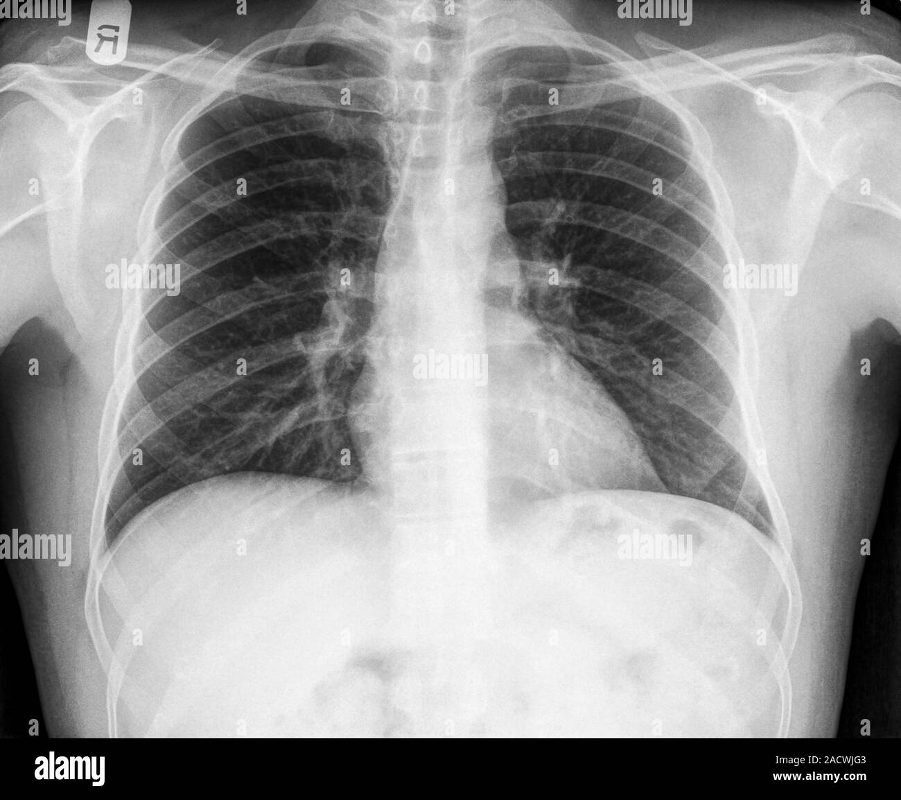 fracture of the number 10 rib can be seen in a Chest x-ray of a 36 year ...