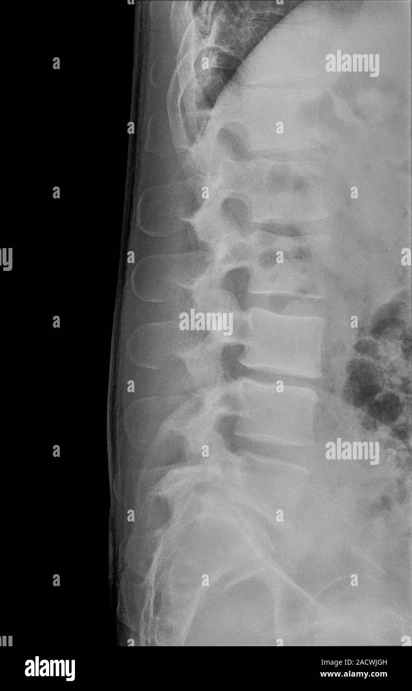 Human Lumbar Spine x-Ray Side View (male 37 years Stock Photo - Alamy