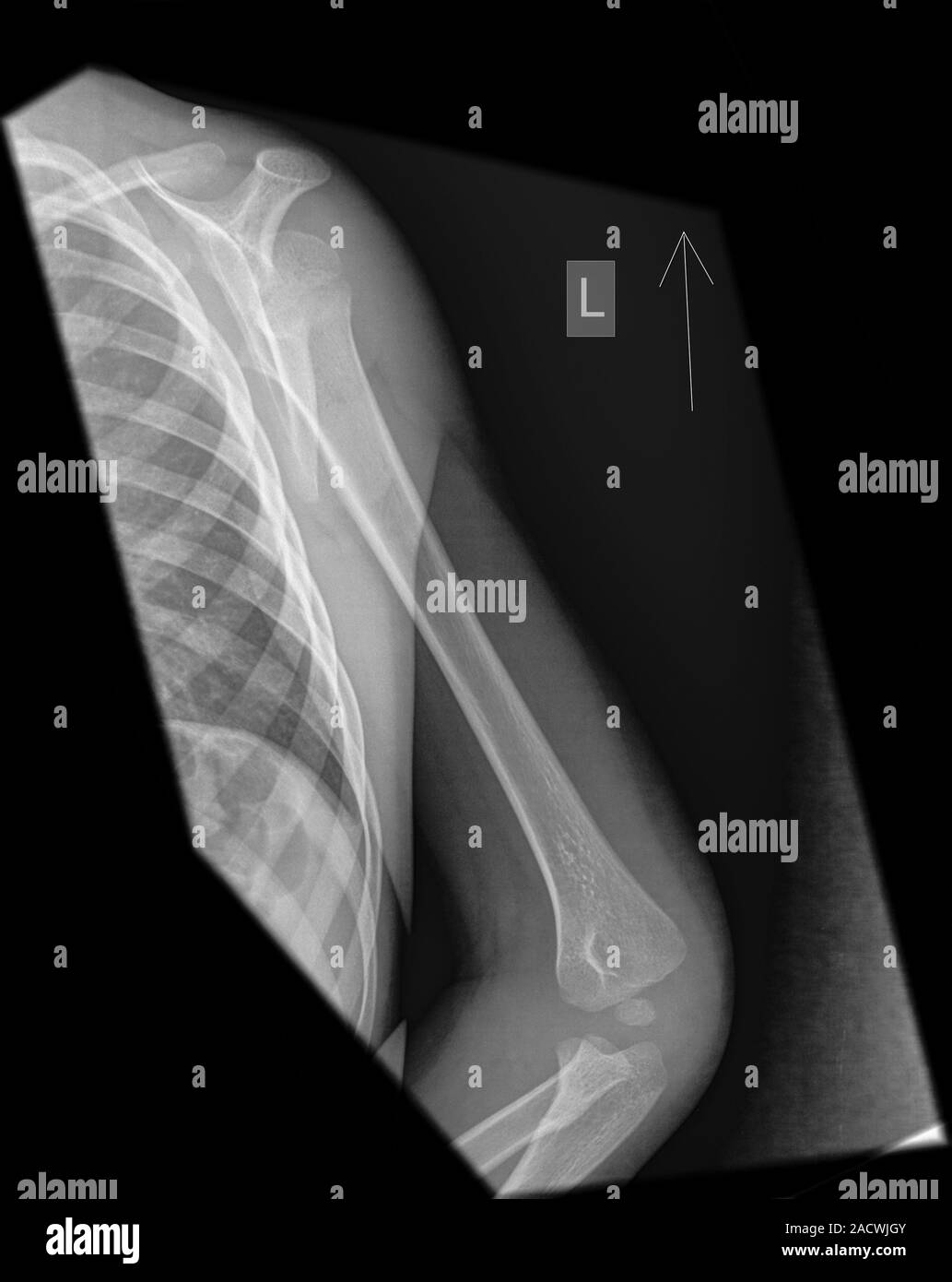 X-ray of a Human forearm with fat pad signs and a Supracondylar humerus ...