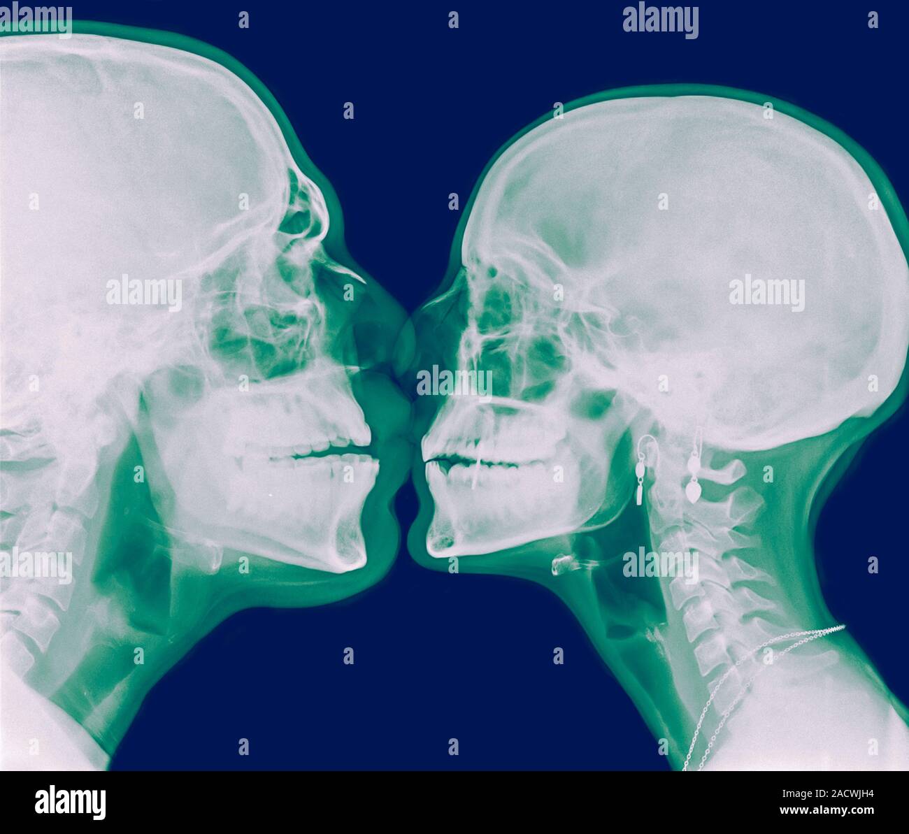 Kissing Couple. Two people kissing under x-ray Stock Photo - Alamy