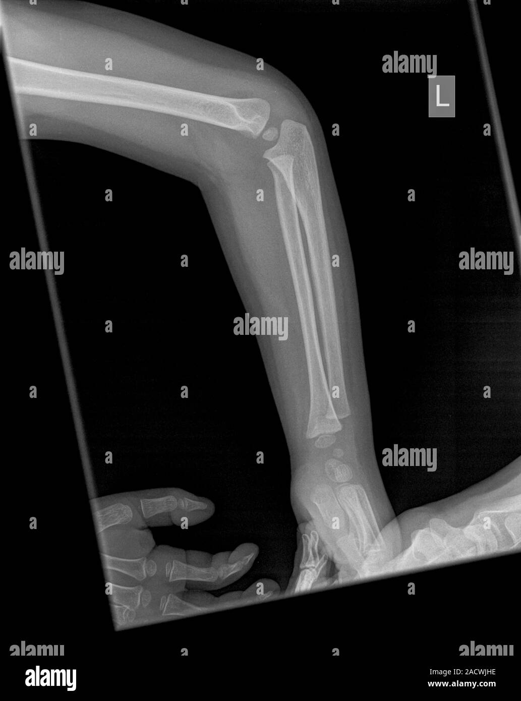 X-ray of a Human forearm with fat pad signs and a Supracondylar humerus ...