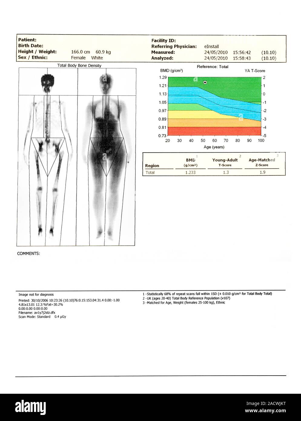 Bone Density Scan Results From A Dexa Dual Energy X Ray