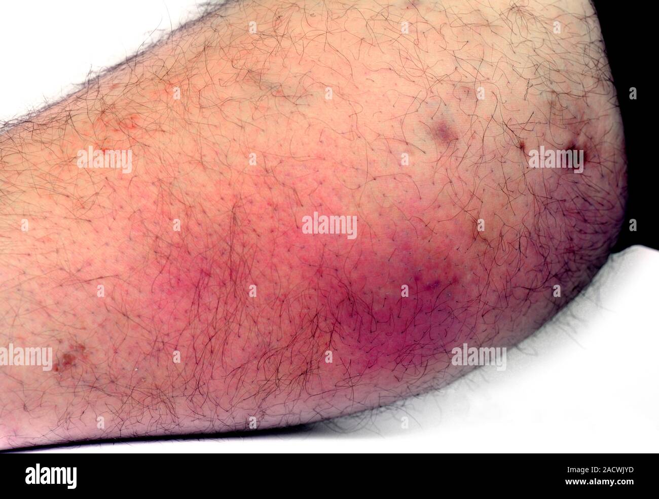 Not for use in Television Not for use in Television Cellulitis skin ...