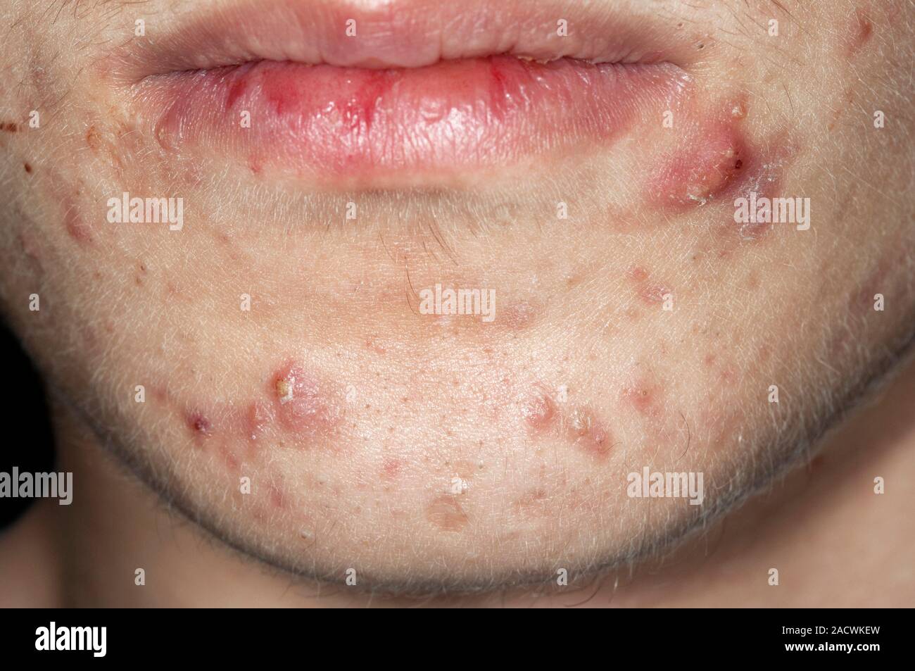 Acne vulgaris on a 20 year old man's face. Acne is a general name given ...
