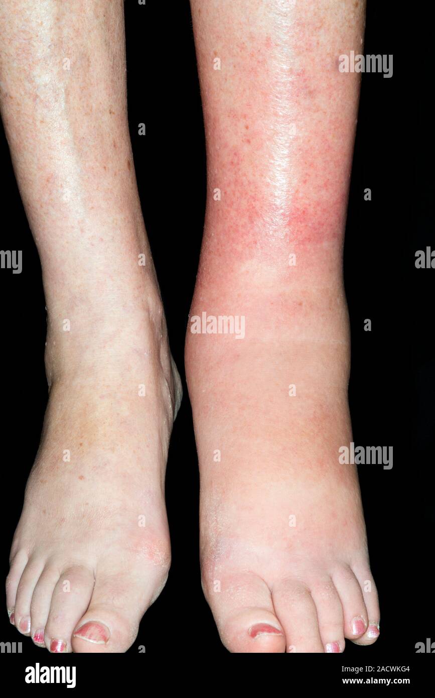 Cellulitis of the left leg (right) of a 62 year old female patient. The ...