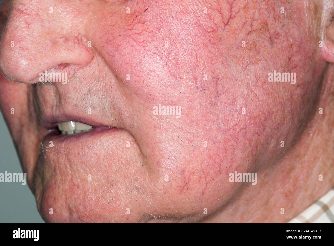 Swollen chin in an 88 year old male patient. This is an allergic ...