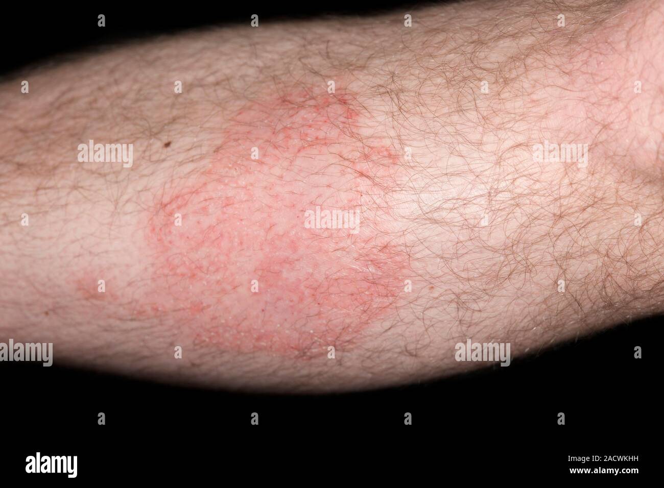 Allergic rash on the shin of a 21 year old male. This reaction was ...