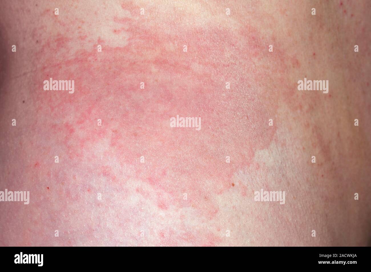 Hives. Weals on the skin of the waist of a 52 year old female patient ...