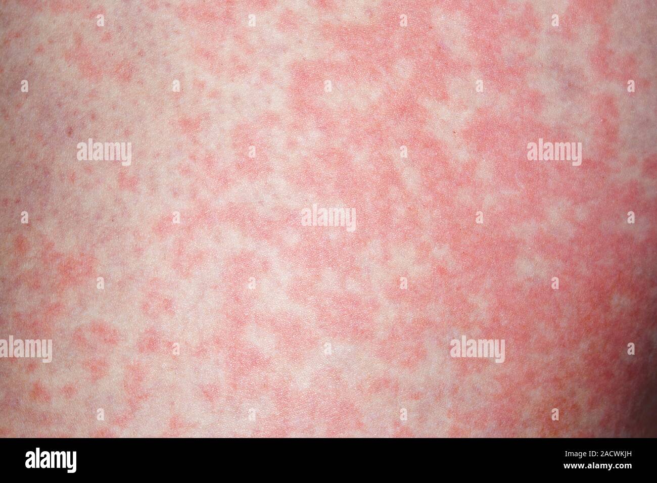 Hives. Weals on the skin of an 18 year old female patient caused by ...