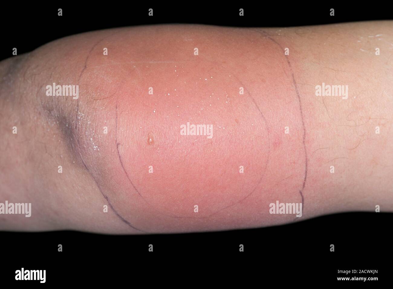 Allergic reaction to insect bite. Swollen skin on the arm of a 35 year ...