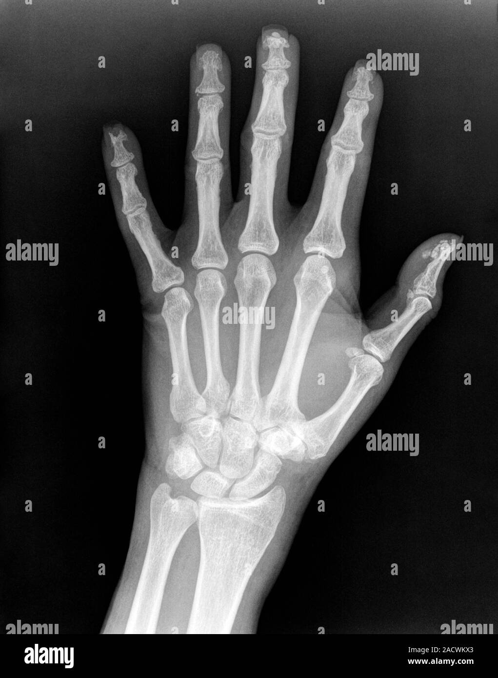 Vasculitis. X-ray of the hand of a 77 year old male patient with ...