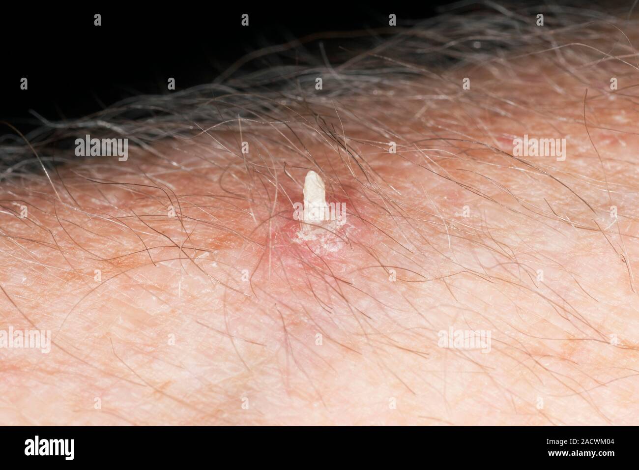 Cutaneous horn on an 81 year old male patient's forearm. These horns ...