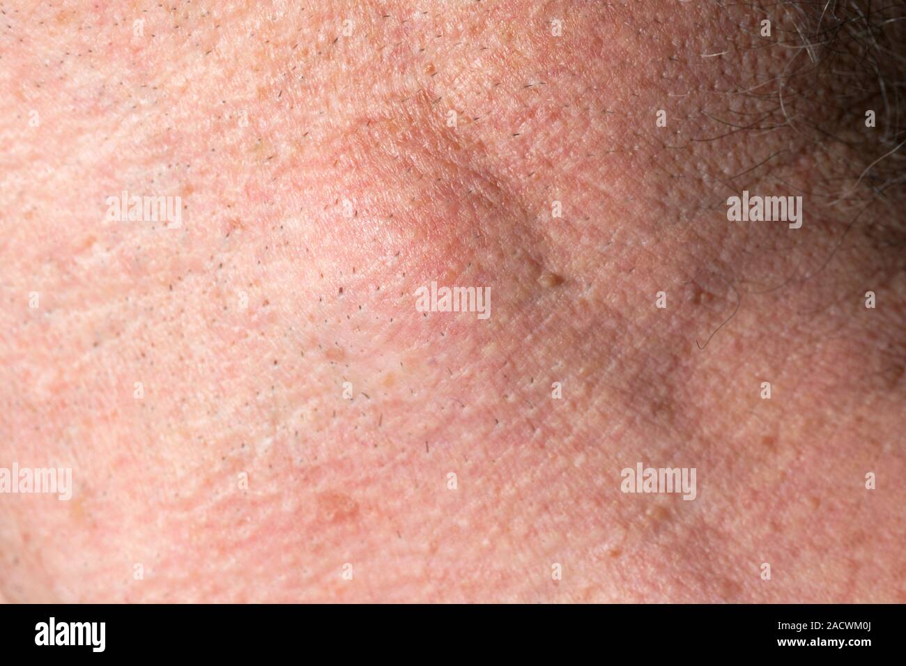 Lipoma In The Neck Of A 68 Year Old Male Patient A Lipoma Is A Benign Non Cancerous Tumour