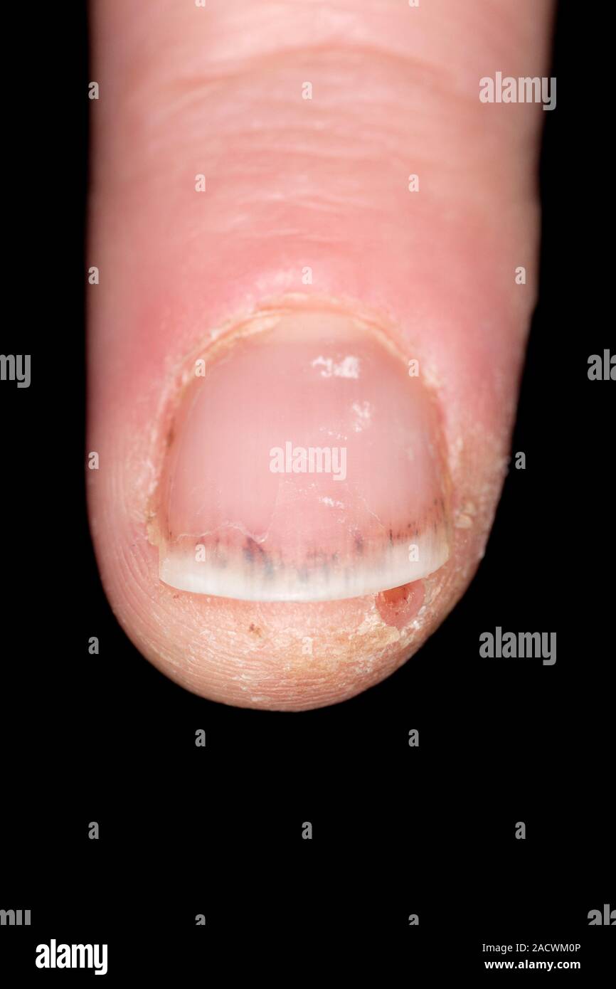 Raynaud's disease. Finger of a 46 year old female patient with Raynaud ...