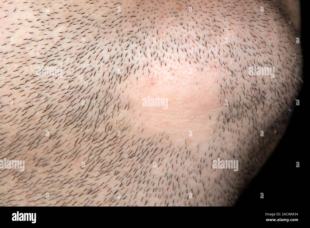 Hair loss. Patches of hair loss in the beard of a 36 year old male ...