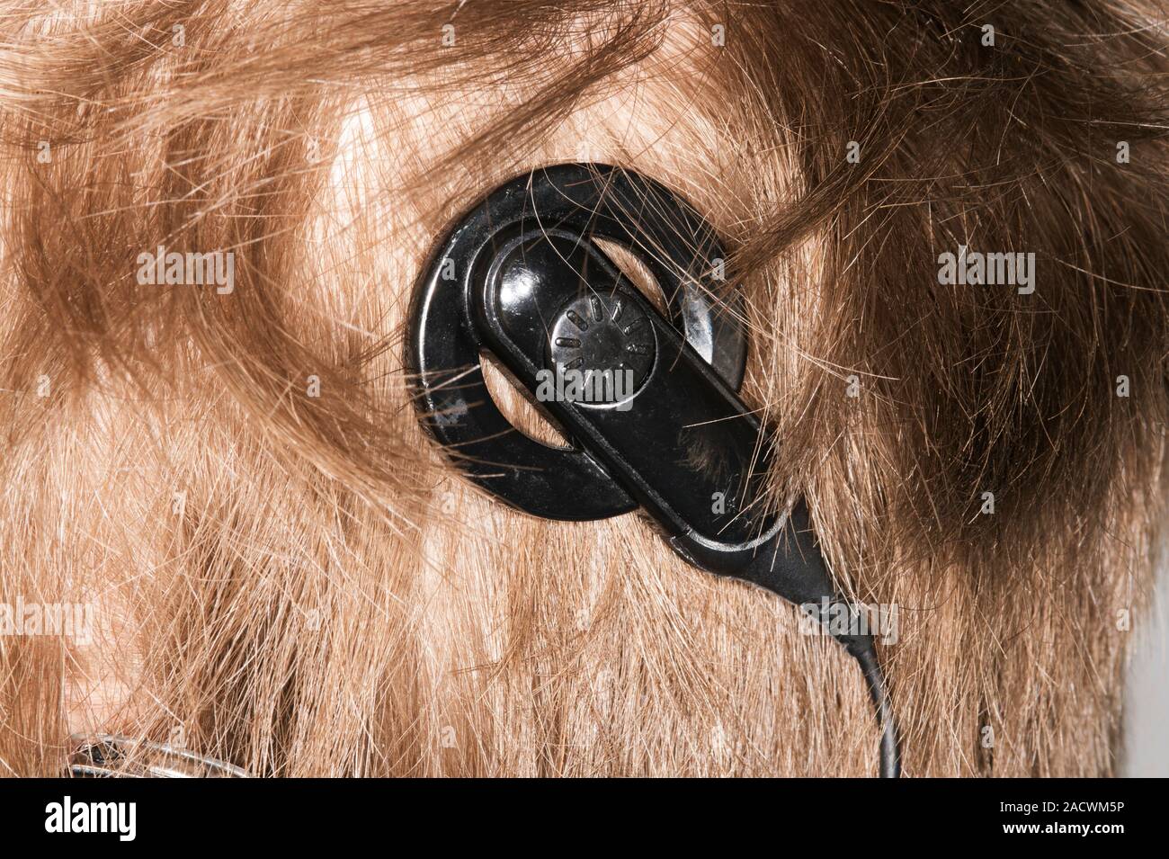 Hearing aid. Cochlear implant transmitter on the scalp of an eight year ...