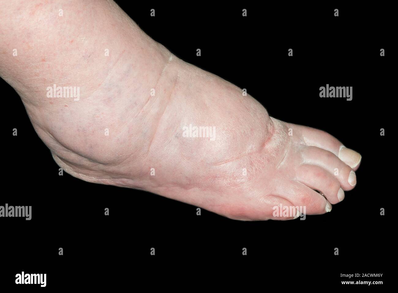 Ankle oedema in an 87 year old female patient. An oedema is a swelling ...