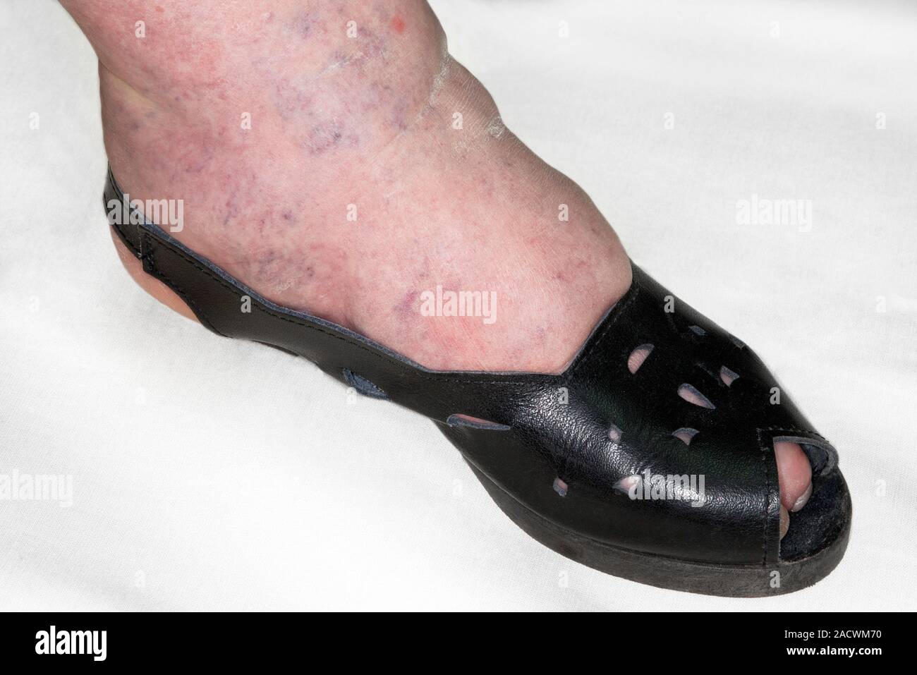 Ankle oedema in an 87 year old female patient. An oedema is a swelling ...