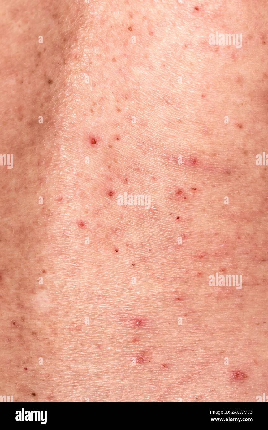 Scabies infection. Red sores and scratch marks on the skin of a 52 year ...