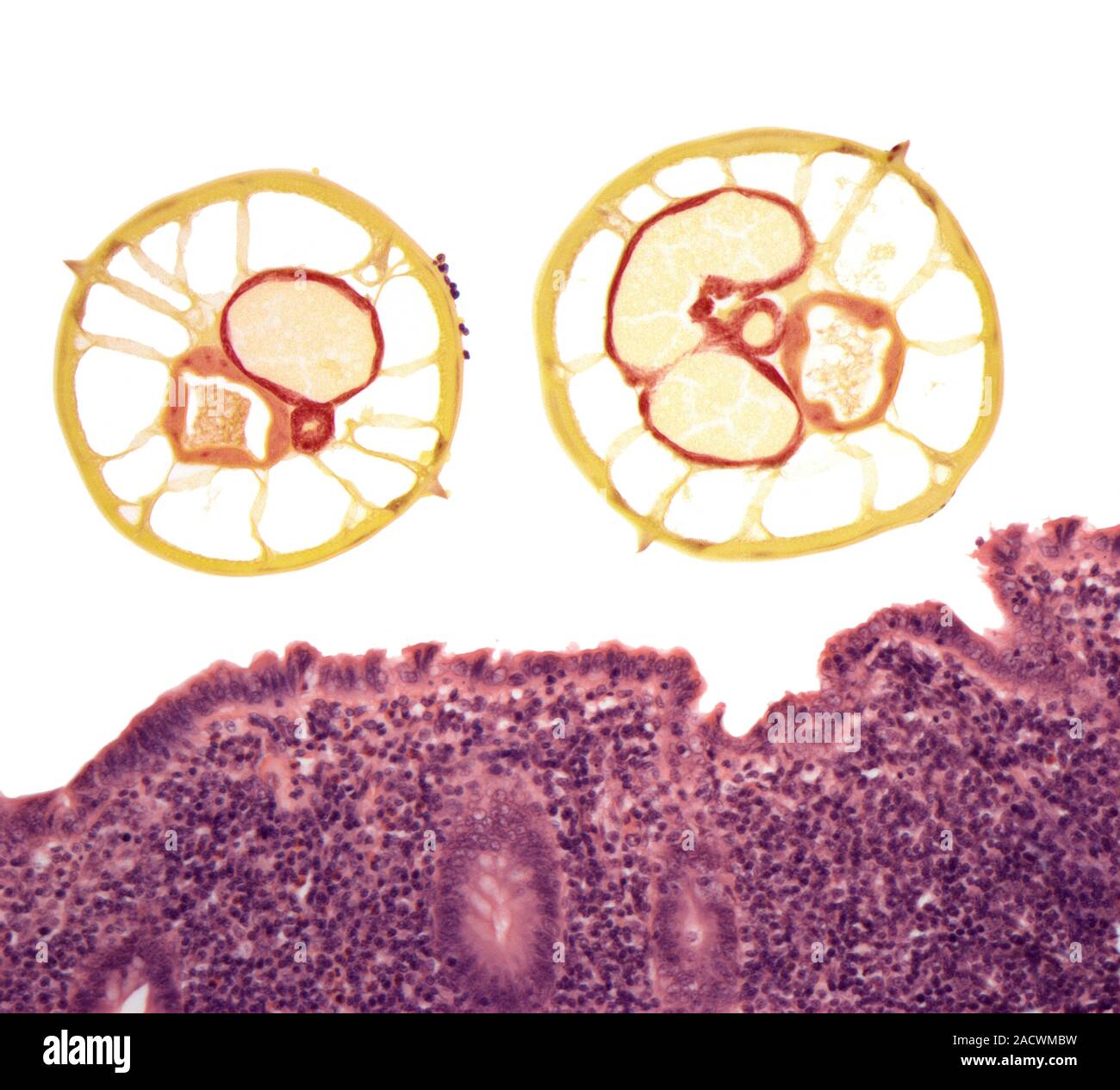 Appendicitis due to threadworm (Enterobius vermicularis) infection ...