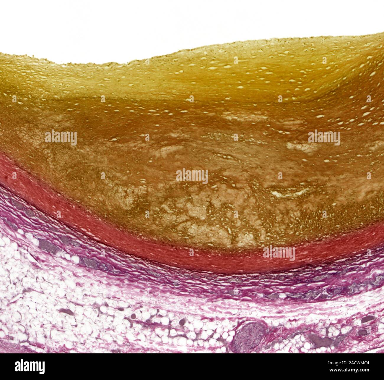 Atherosclerosis. Light micrograph of a section through an artery ...