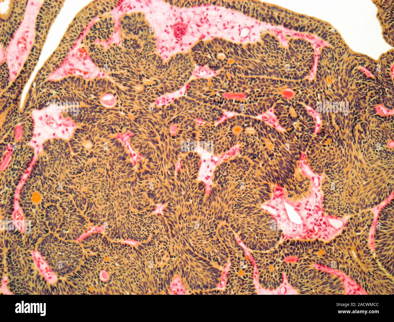Inverted papilloma of the bladder. Light micrograph of a section ...
