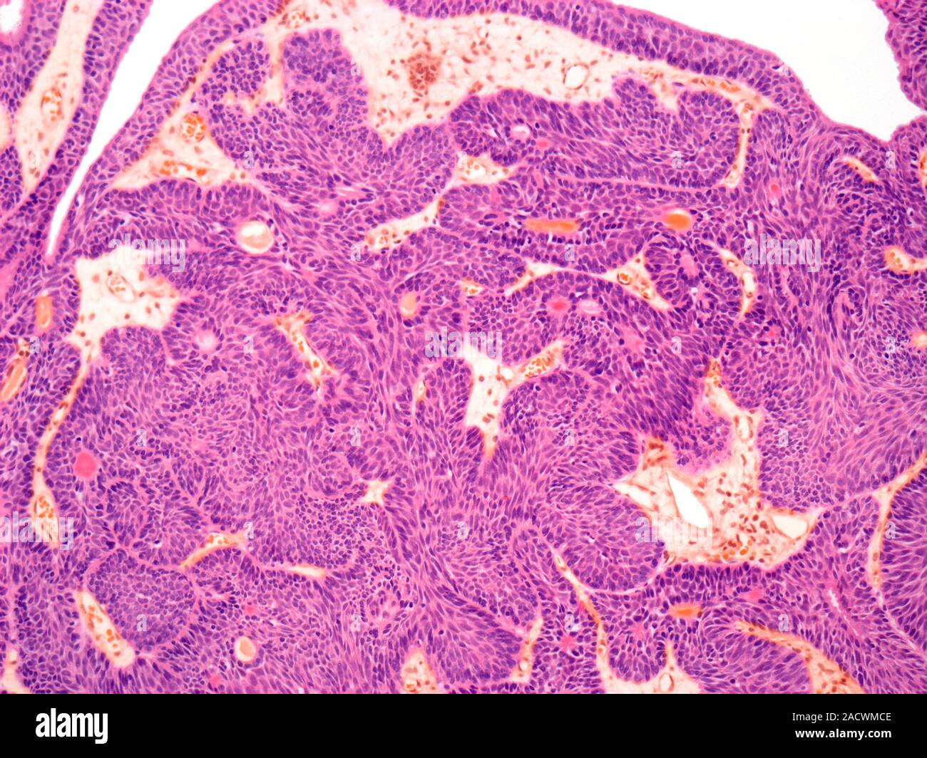 Inverted papilloma of the bladder. Light micrograph of a section ...
