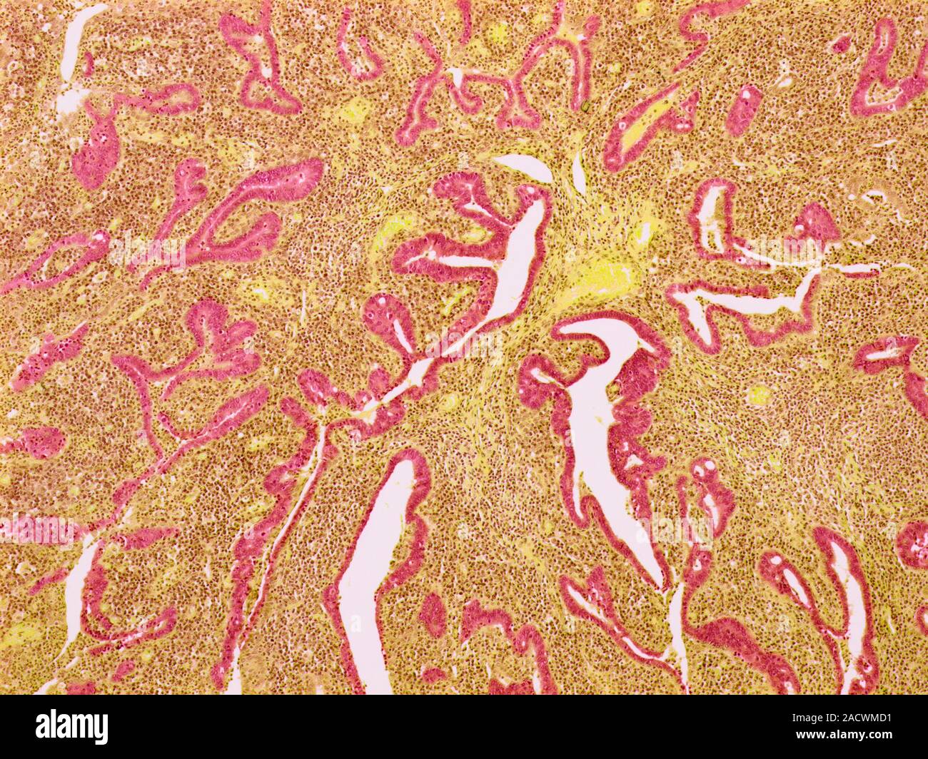 Inflamed fallopian tube. Light micrograph of a section through a ...