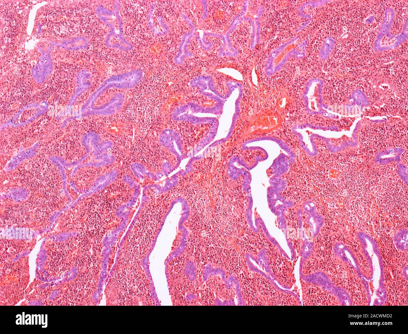 Inflamed fallopian tube. Light micrograph of a section through a ...