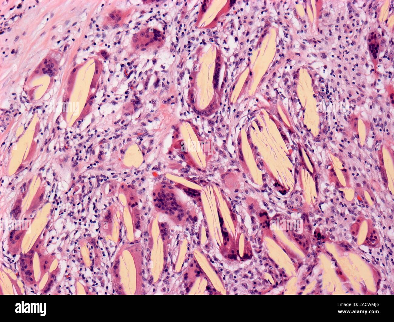 Cholesterol granuloma, light micrograph. Cholesterol granulomas are ...
