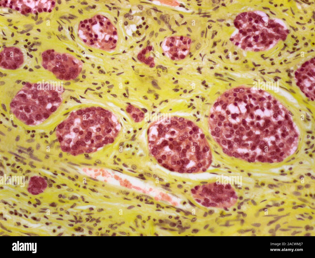 Colon cancer. Light micrograph of a section through a carcinoid tumour ...