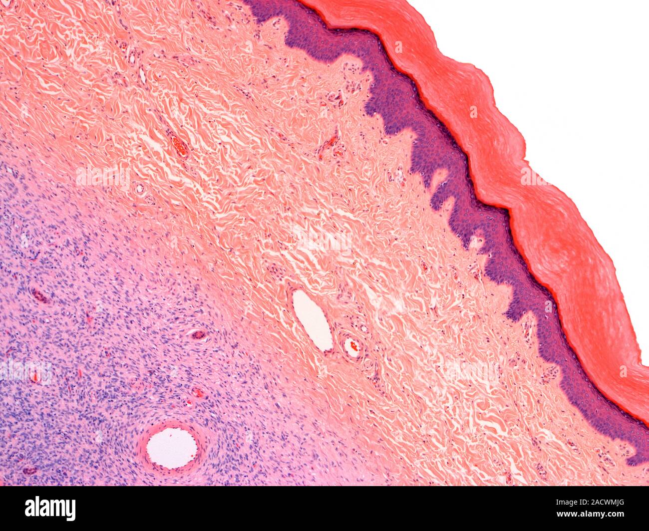 Skin cancer. Light micrograph of a section through a ...