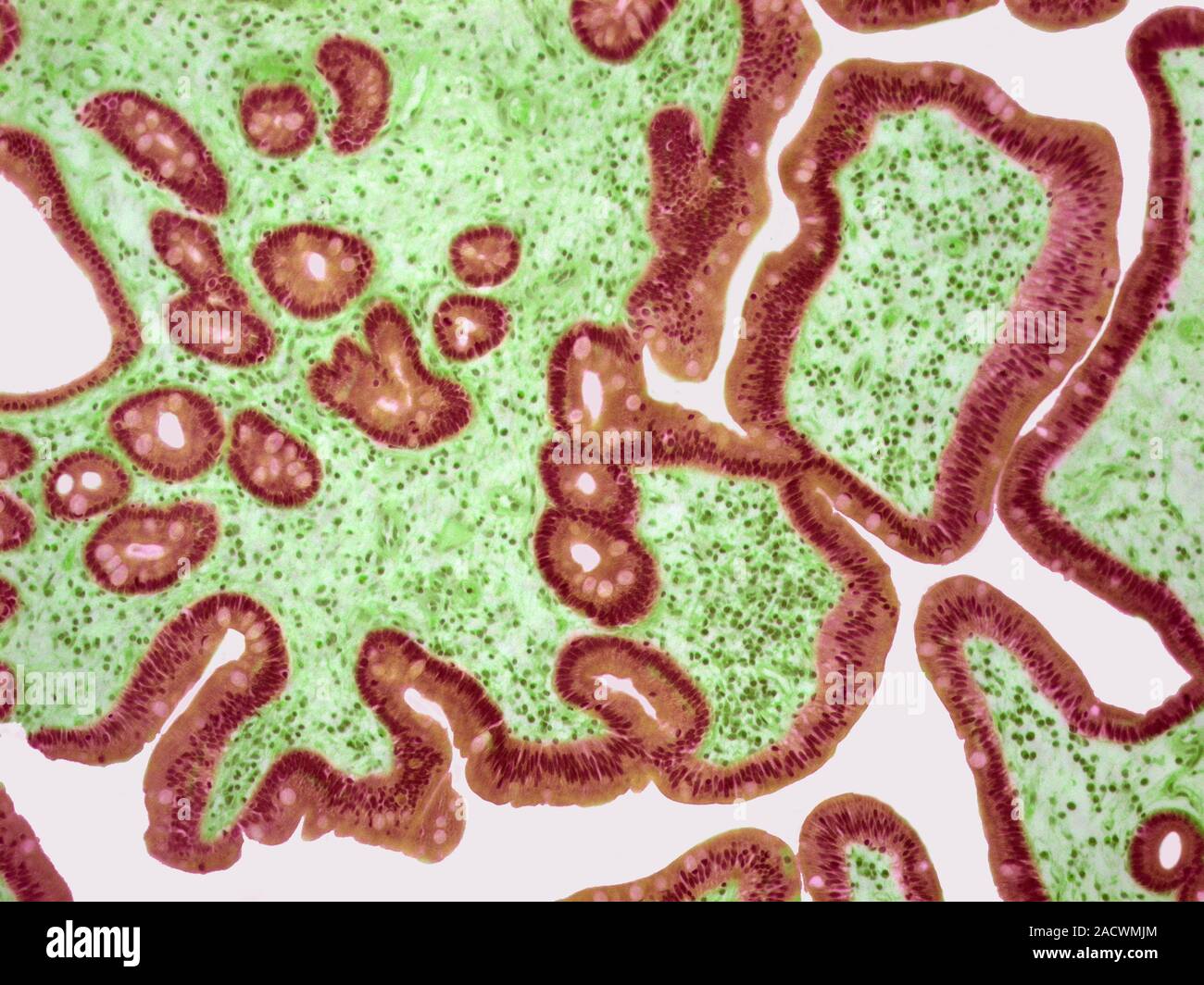 Intestinal polyp. Light micrograph of a section through a polyp in the ...