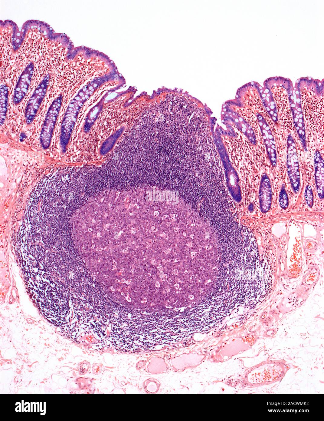 Crohns Disease Light Micrograph Of A Section Through An Intestine In The Early Stages Of Crohn