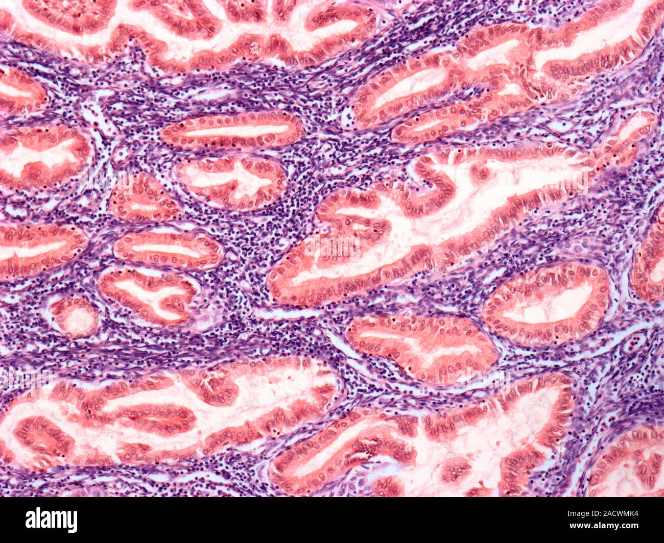 Endometrial hyperplasia. Light micrograph of a section through tissue ...