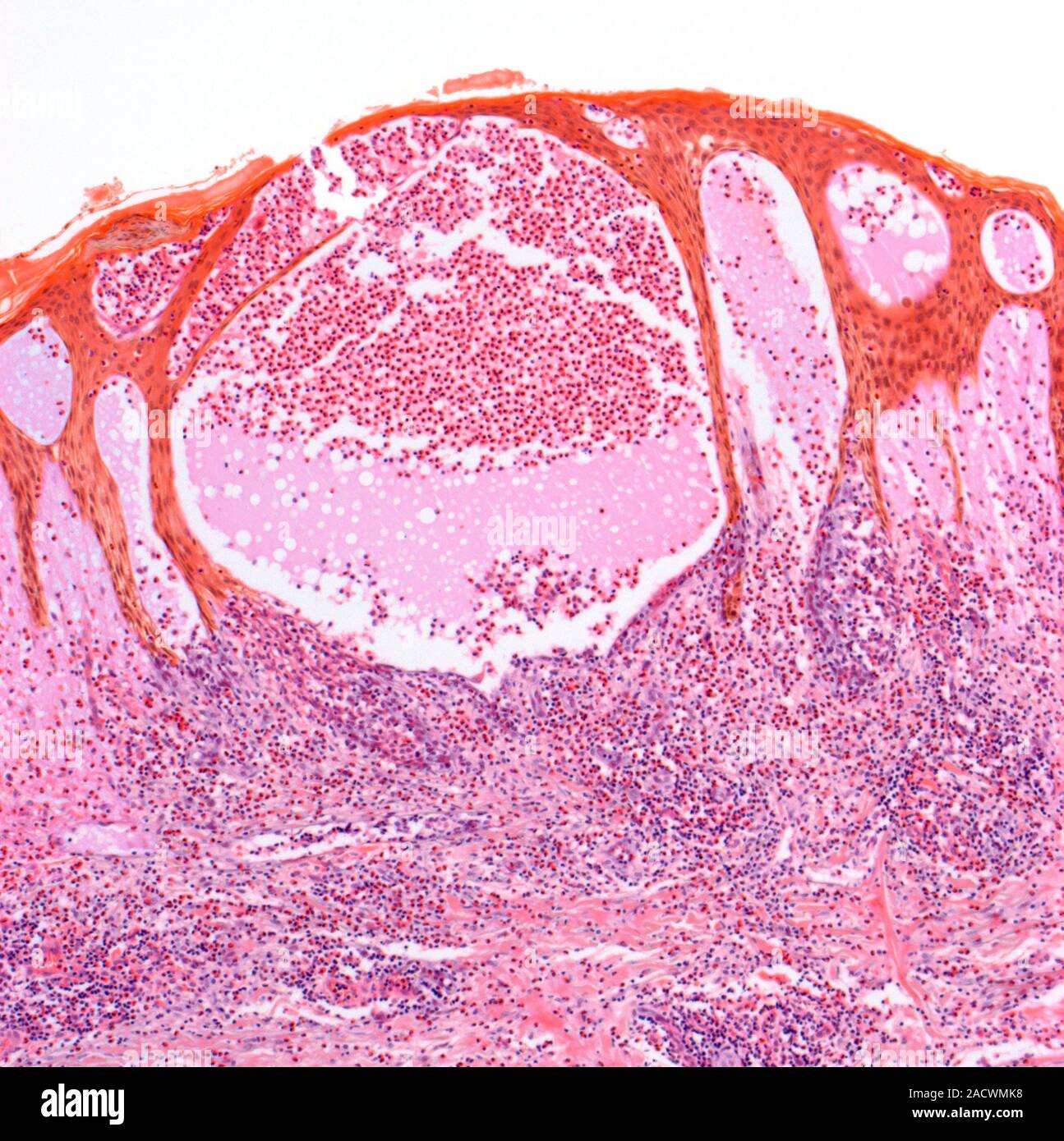 Wells syndrome. Light micrograph of a section through skin affected by ...