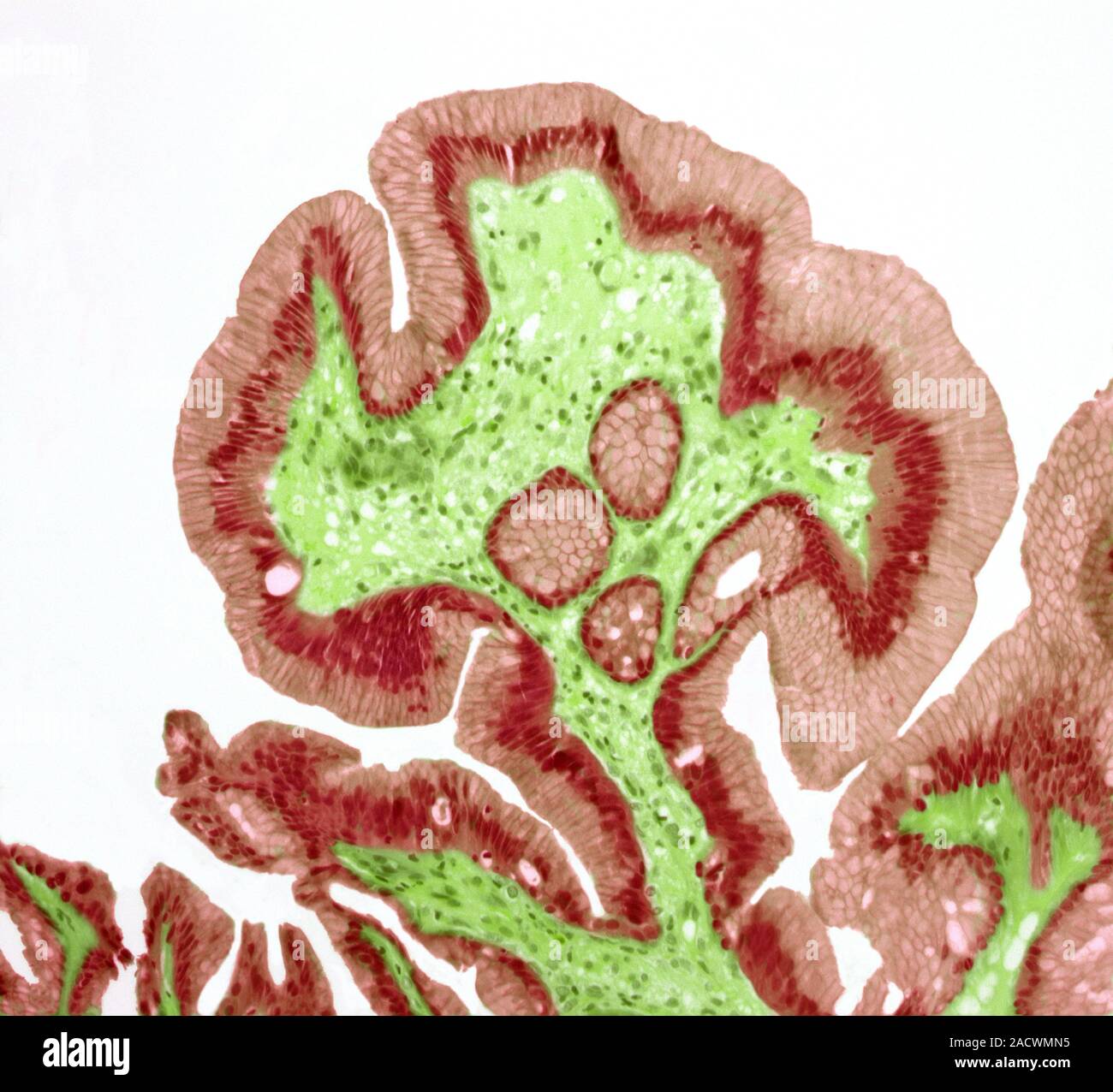 Hyperplastic polyp. Light micrograph of a section through a ...