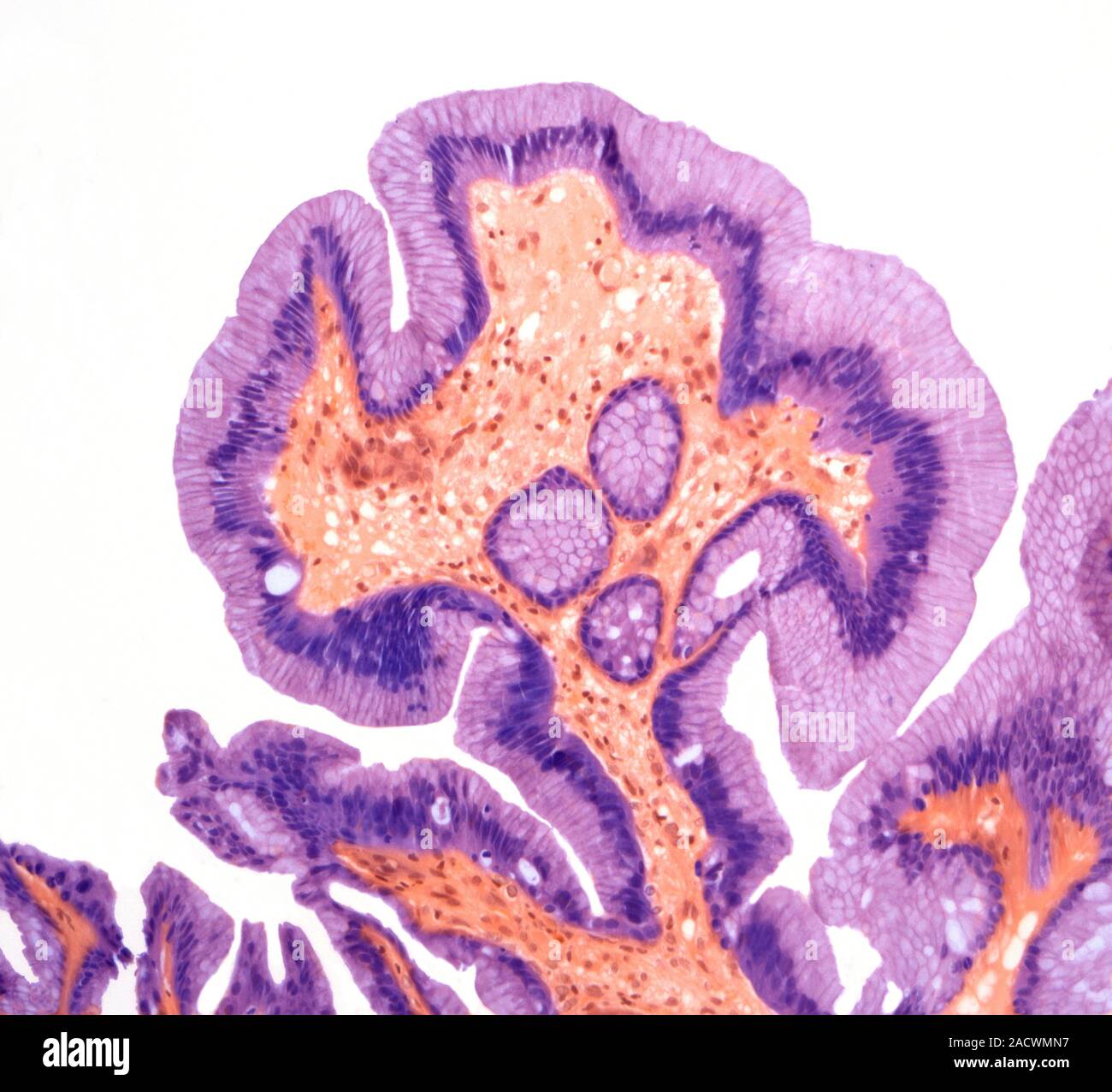 Hyperplastic Polyp Light Micrograph Of A Section Through A