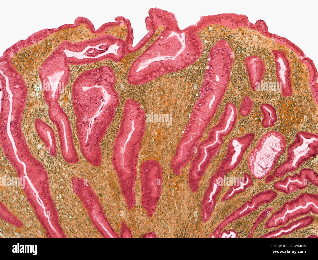 Hyperplastic polyp. Light micrograph of a section through a ...
