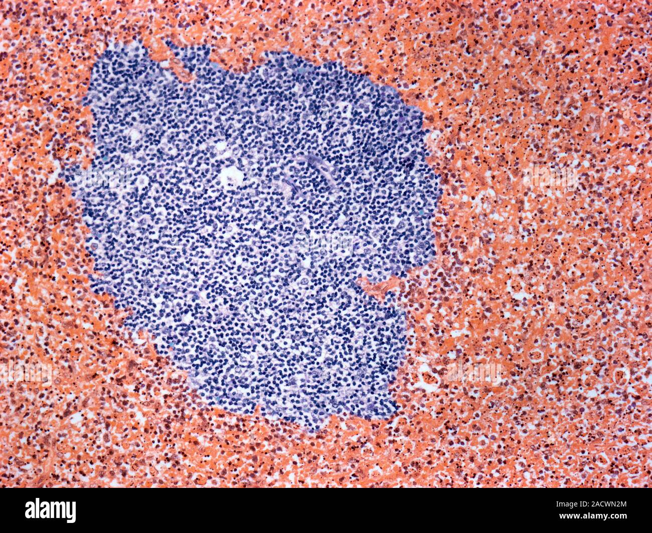 Kikuchi Fujimoto Disease Light Micrograph Of A Section Through A Lymph
