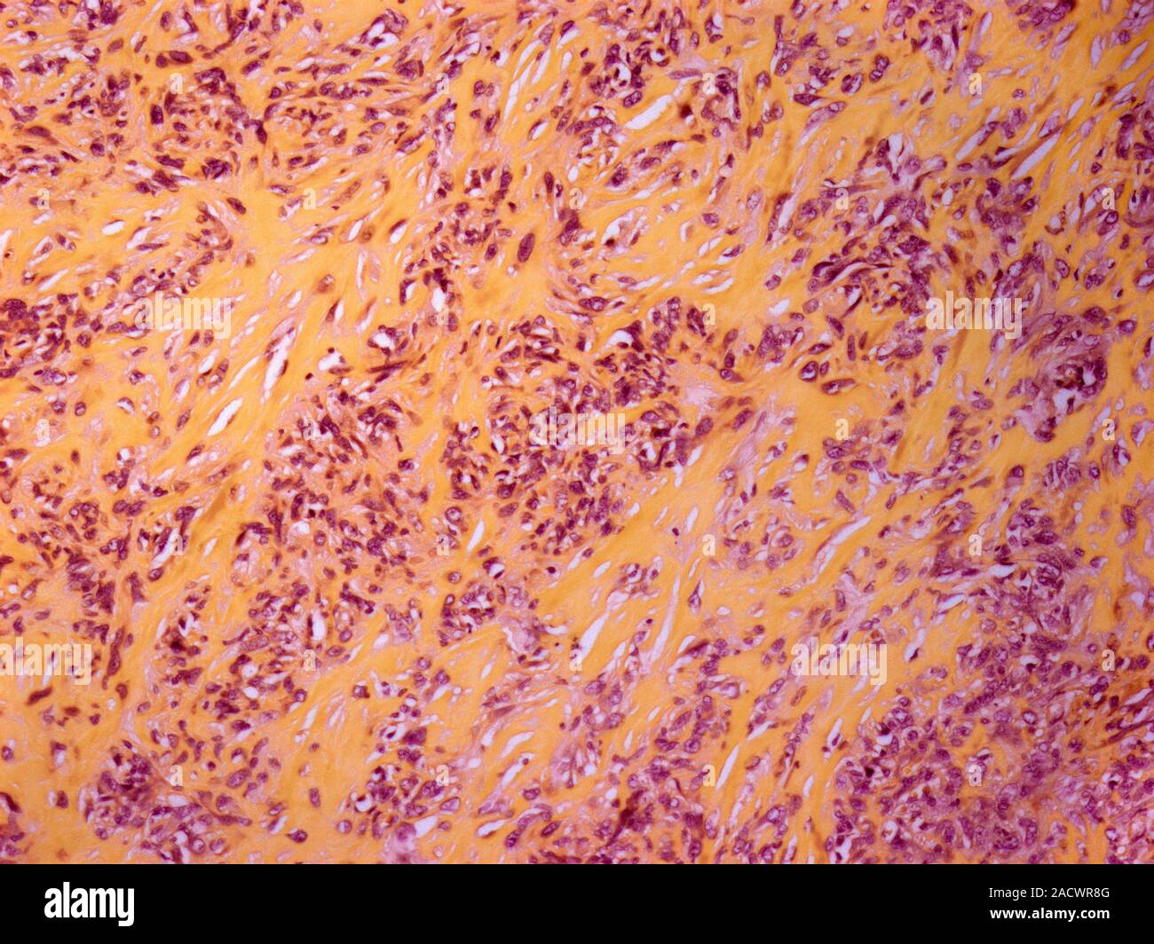 Smooth muscle cancer. Light micrograph of a section through a ...